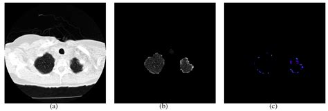 Pulmonary Nodule Detection From X Ray Ct Images Based On Region Shape