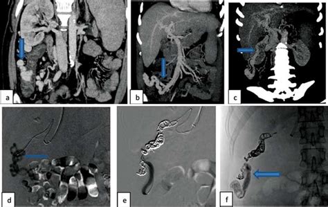 Elderly Man Presented With A Lower Gi Bleed A Ct Shows The Cecal Download Scientific Diagram