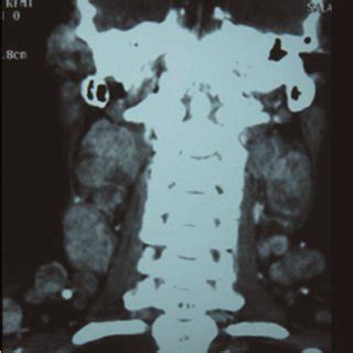 Computed Tomography Of The Patient Showing Diffuse Lymphadenopathy In Download Scientific