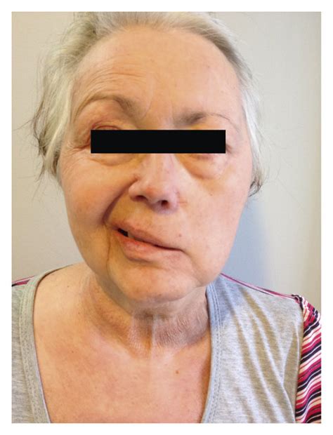 Left Sided Peripheral Facial Nerve Palsy With An Inability To Wrinkle