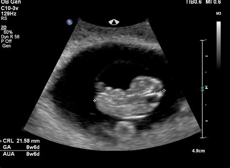 Early Ultrasound 7 10 Weeks In Eindhoven 040verloskunde
