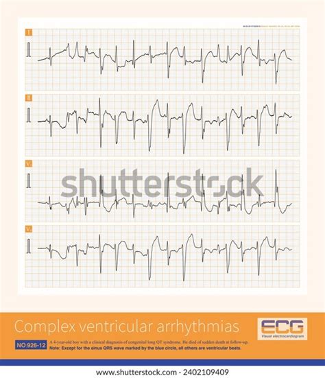 Year Old Babe Clinical Diagnosis Long Qt Stock Illustration Shutterstock