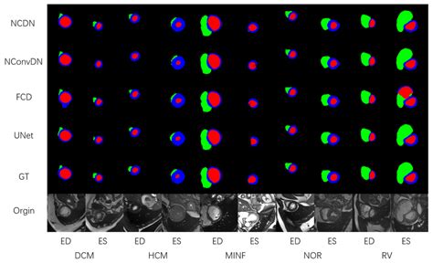 Segmentation Of Biventricle In Cardiac Cine Mri Via Nested Capsule Dense Network [peerj]