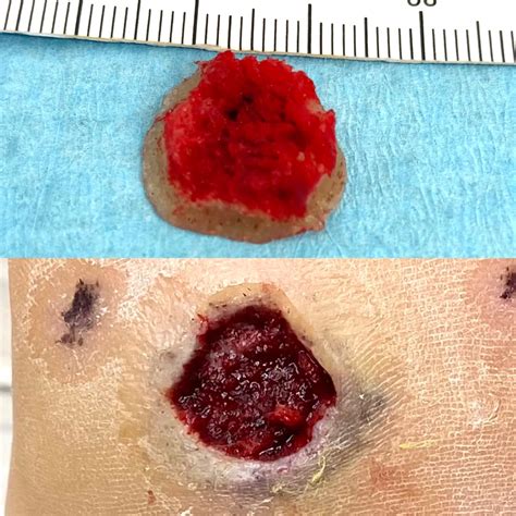 Plantar Wart Root Diagram