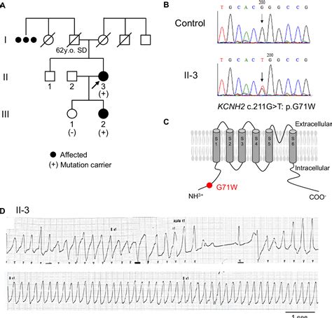 A Case Of Long Qt Syndrome Type 2 That Developed Torsades De Pointes