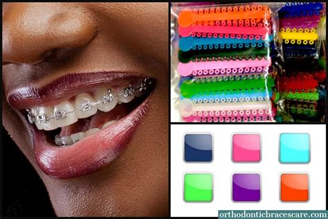 Best Braces Colors For Dark Skin How To Choose Artofit