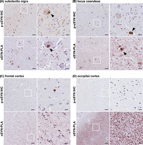 Discrepancy Between Distribution Of Alpha Synuclein Oligomers And Lewy Related Pathology In