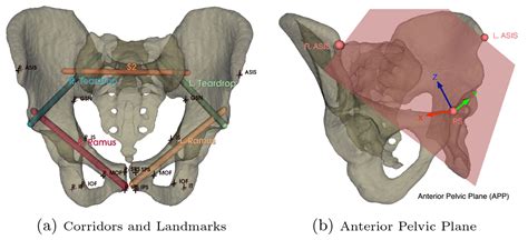 Pelphix Surgical Phase Recognition From X Ray Images In Percutaneous Pelvic Fixation Pmc