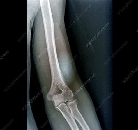 Contraceptive Implant X Ray Stock Image C Science Photo Library
