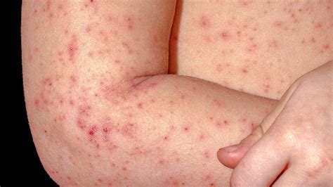 Little Red Bumps On Skin Royal Ogburn