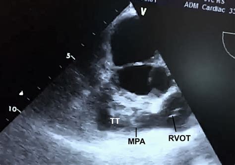 Transthoracic Echocardiograms Show A A Mm Mass In The Inferior Download Scientific