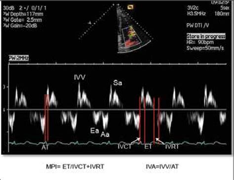 Figure 1 From Subclinical Left Ventricular Systolic Dysfunction In Patients With Mild To
