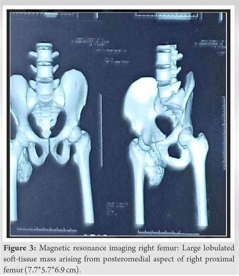 A Rare Case Of Solitary Osteochondroma Of Right Hip With Unusual Clinical Presentation Journal