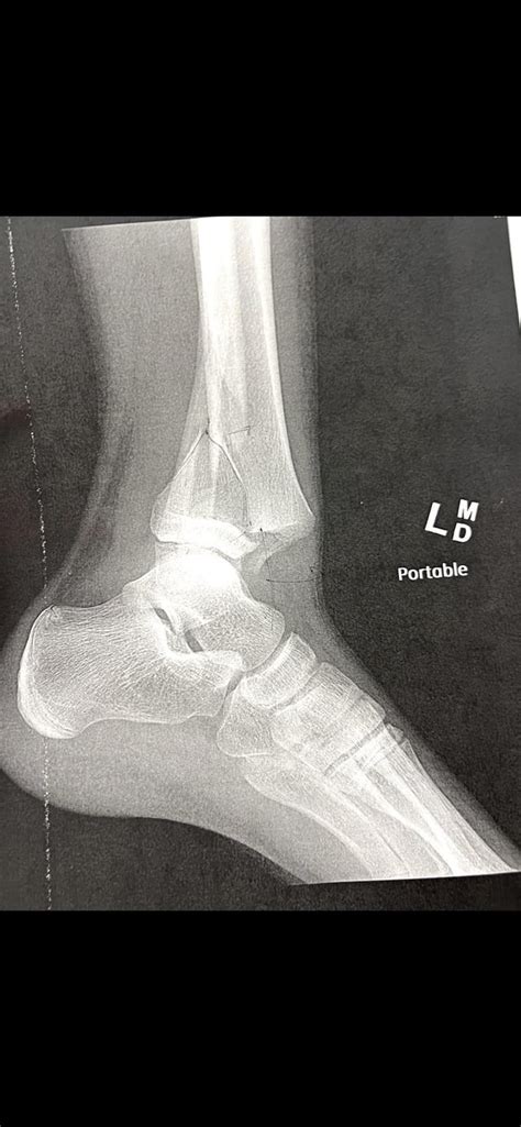 Guess How Tibiafibuladislocation Rxrayporn