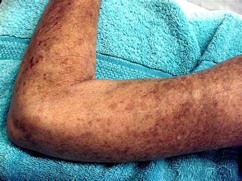 Scleroderma Skin Cancer And Dermatology Clinic