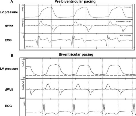 Left Ventricular Pressure Tracing Dp Dt And Dp Dt Min Obtained Using