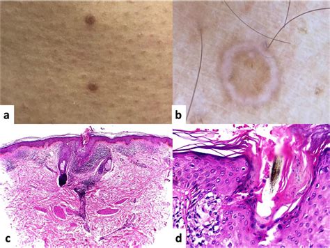 [translated Article] Is Follicular Porokeratosis A Distinct Clinical Variant Actas Dermo