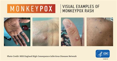 How Does Monkeypox Spread Common Questions And How To Protect Yourself Nebraska Medicine