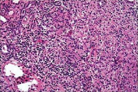 Tubulo Interstitial Nephropathy 1 Ppt