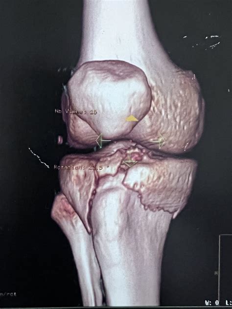 Proximal Tibia Fracture Anatomical Reduction Is The Key For Optimal Functional Outcome