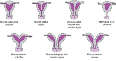 Uterus Bicornis Schwangerschaft Trotz Uterusanomalie