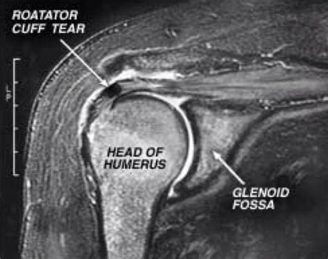 Will Mri Show Torn Muscle Mapasgmaes