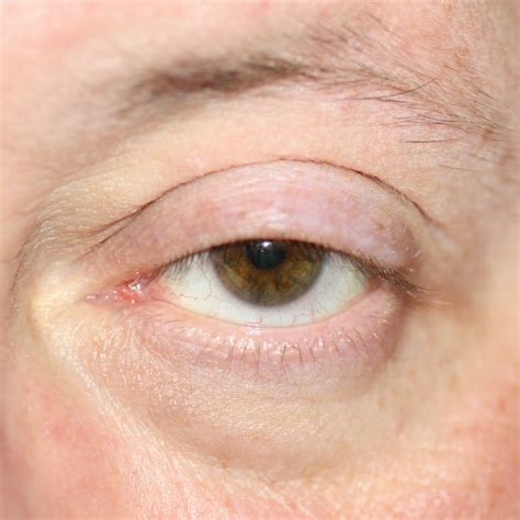 Droopy Lower Eyelid