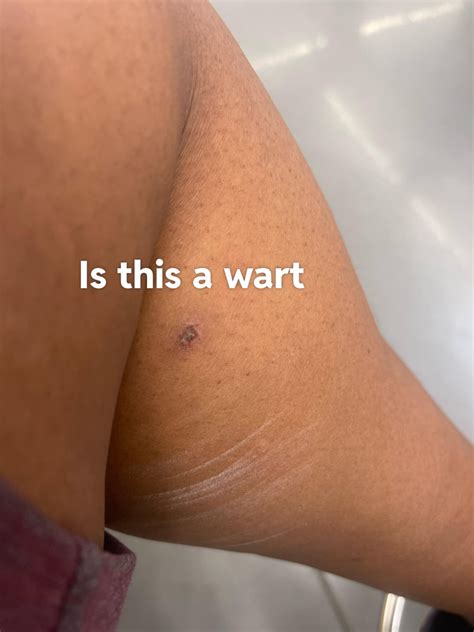 Is This A Wart It Just Randomly Appeared Doesnt Hurt Or Nothing But
