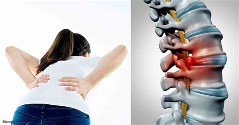 What Causes Sciatica