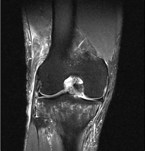 Mri Is This Full Or Partial Tear R Acl
