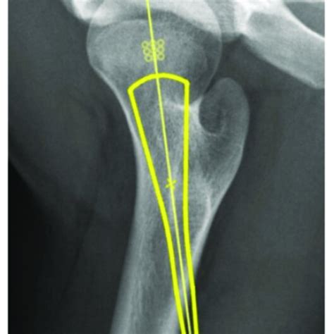 digital templating of the metha stem stha in an anteroposterior a