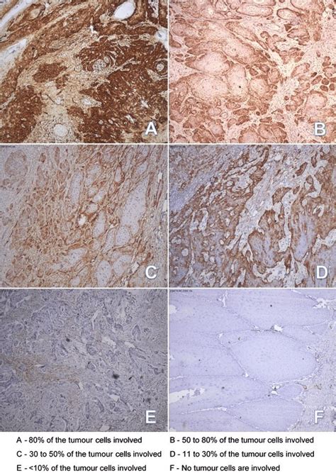 Staining Intensity Of Tumor Cells Download Scientific Diagram