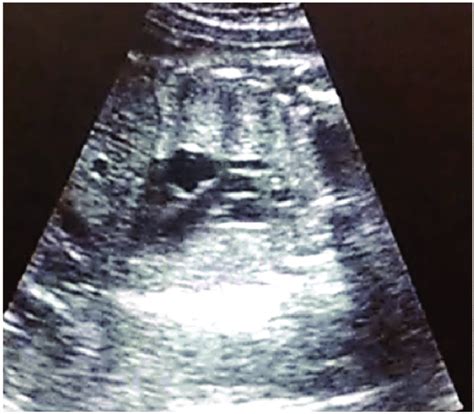 Bilateral Echogenic Lungs And Flat Diaphragm A Characteristic