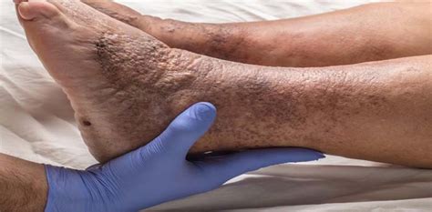 World Thrombosis Day And How It Shapes Your Health Punch Newspapers