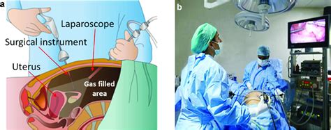 A Laparoscopic Surgery B Surgeons Viewing Inside The Abdomen On Download Scientific