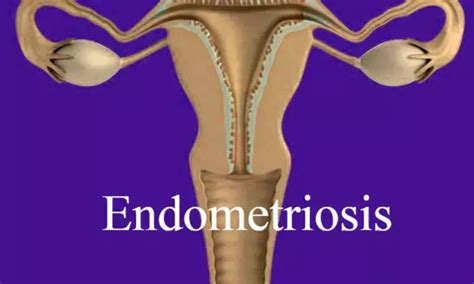 Resection Of Rectosigmoid Endometriosis May Not Impact Pregnancy And