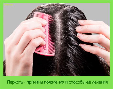 Перхоть - причины появления и способы её лечения
