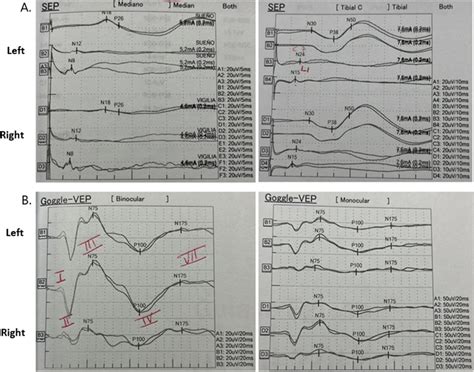 Somatosensory Evoked Potentials Of The Patient A Median Nerve