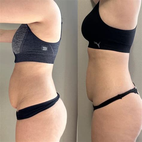 Body Sculpting After Pregnancy Postpartum Recovery