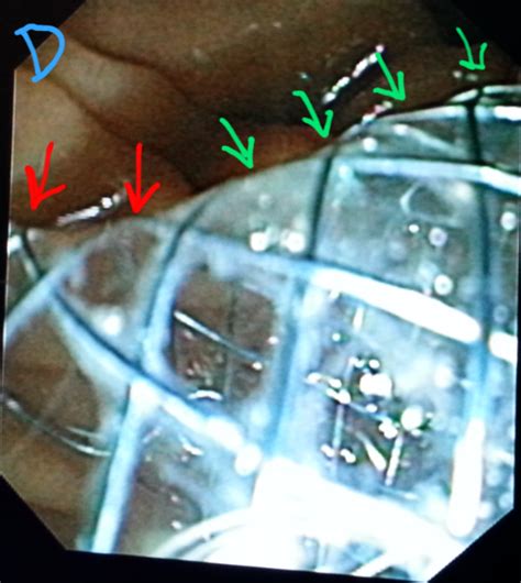 Ercp And Egd Cholangiocarcinoma Below The Confluence