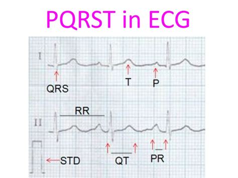 ECG Waveform Explained EKG Labeled Diagrams And Components OFF