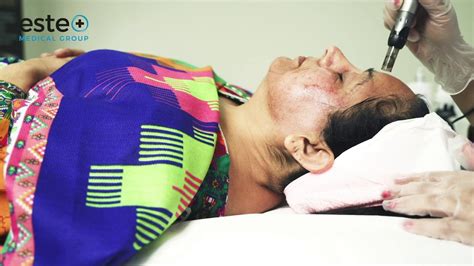 What Is A Dermapen Treatment Este Medical Group Skincare Tips