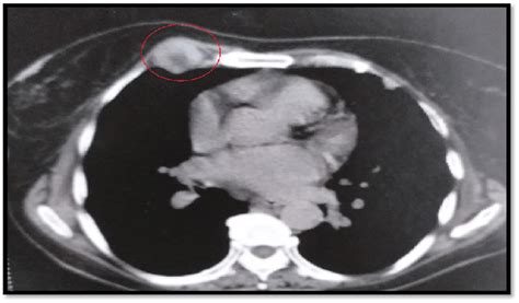 Axial Section Of A Thoracic Ct Scan Showing A Metastatic Pleural Nodule Download Scientific