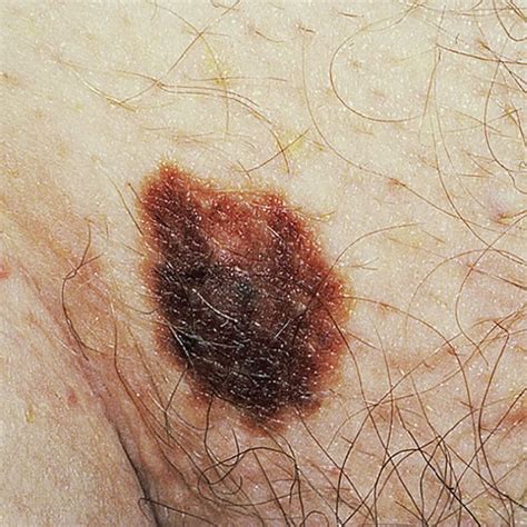 Dark Colored Papules And Nodules Archives Vulvovaginal Disorders
