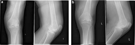 Figure 1 From A Case Of Subchondral Insufficiency Fracture Of The Knee