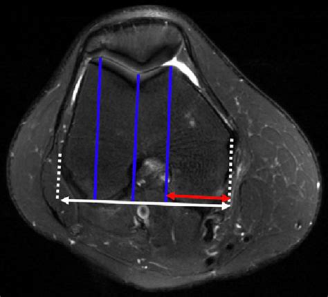 To Assess The Role Of The Trochlear Position On The Femur The Deepest Download Scientific