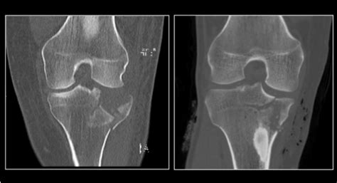 Ultra Low Dose Ct Scans Successfully Detect Fractures Medical Design And Outsourcing