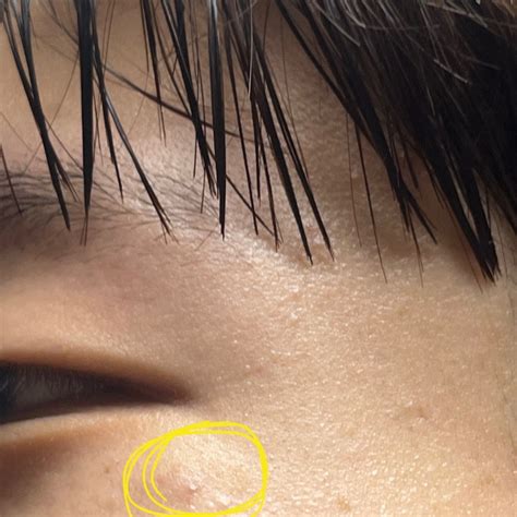 얼굴에 피지낭종인가요 지식in