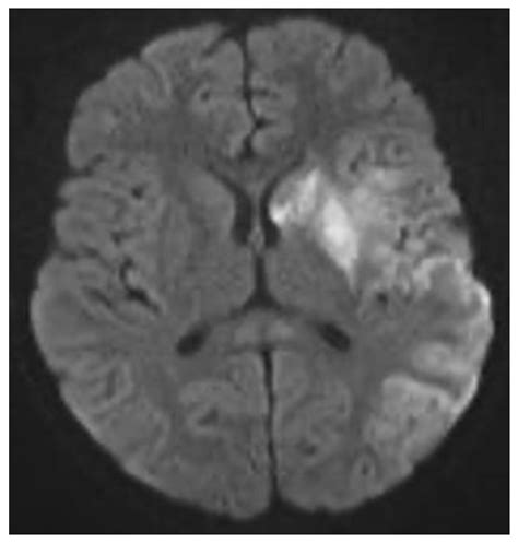 Diffusion Axial Slice Of Mri Brain Showing Areas Of Restriction On Download Scientific Diagram