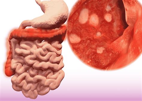 Ischemic Colitis With Multiple Perforations Burjeel Hospital